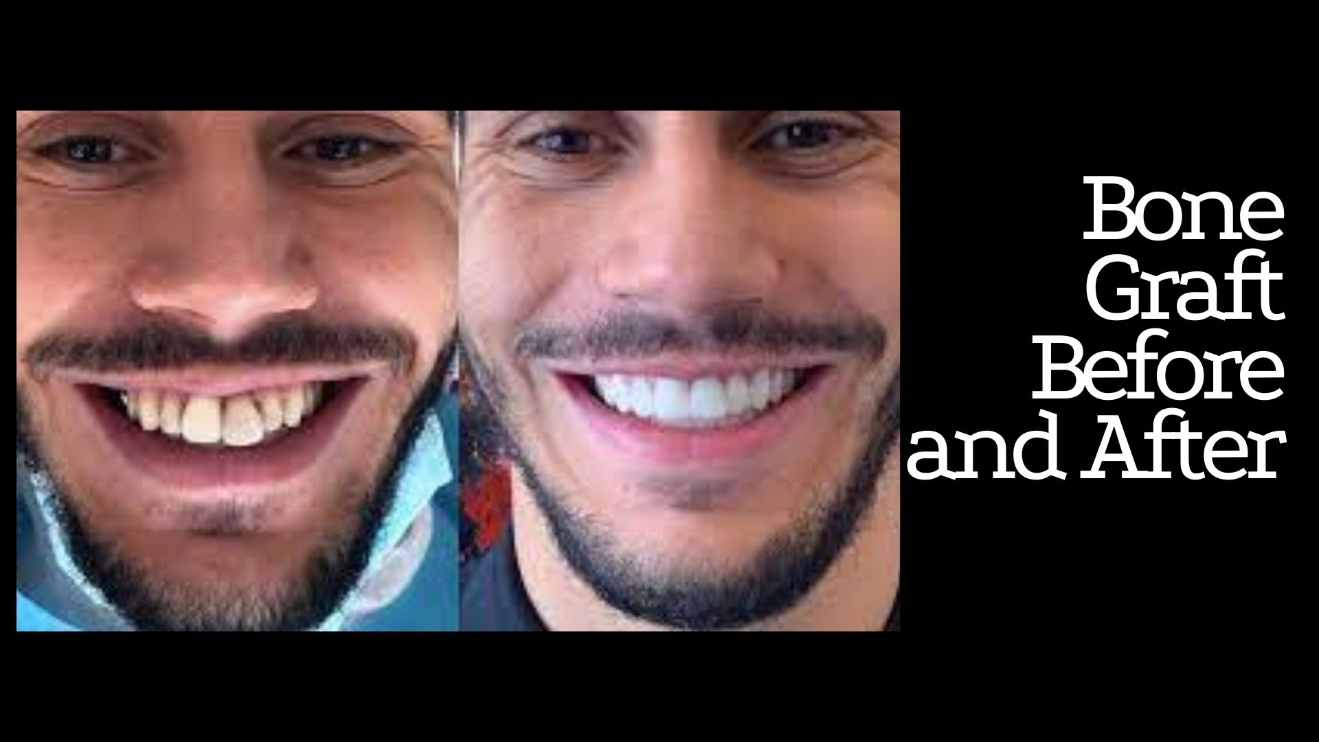 Bone Graft Before and After | Procedure, Recovery & Results