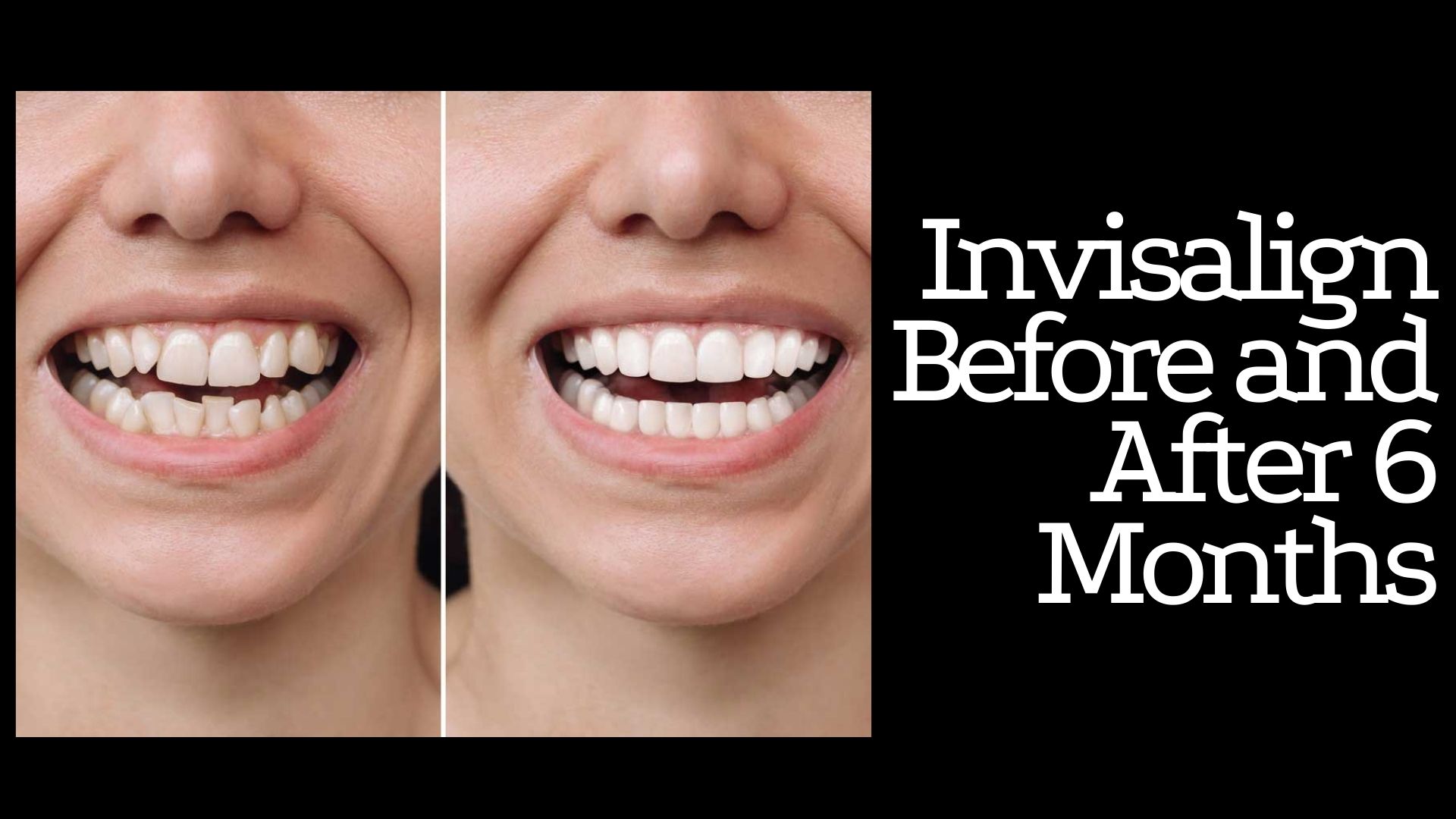 Invisalign Before and After 6 Months - Smile Transformation