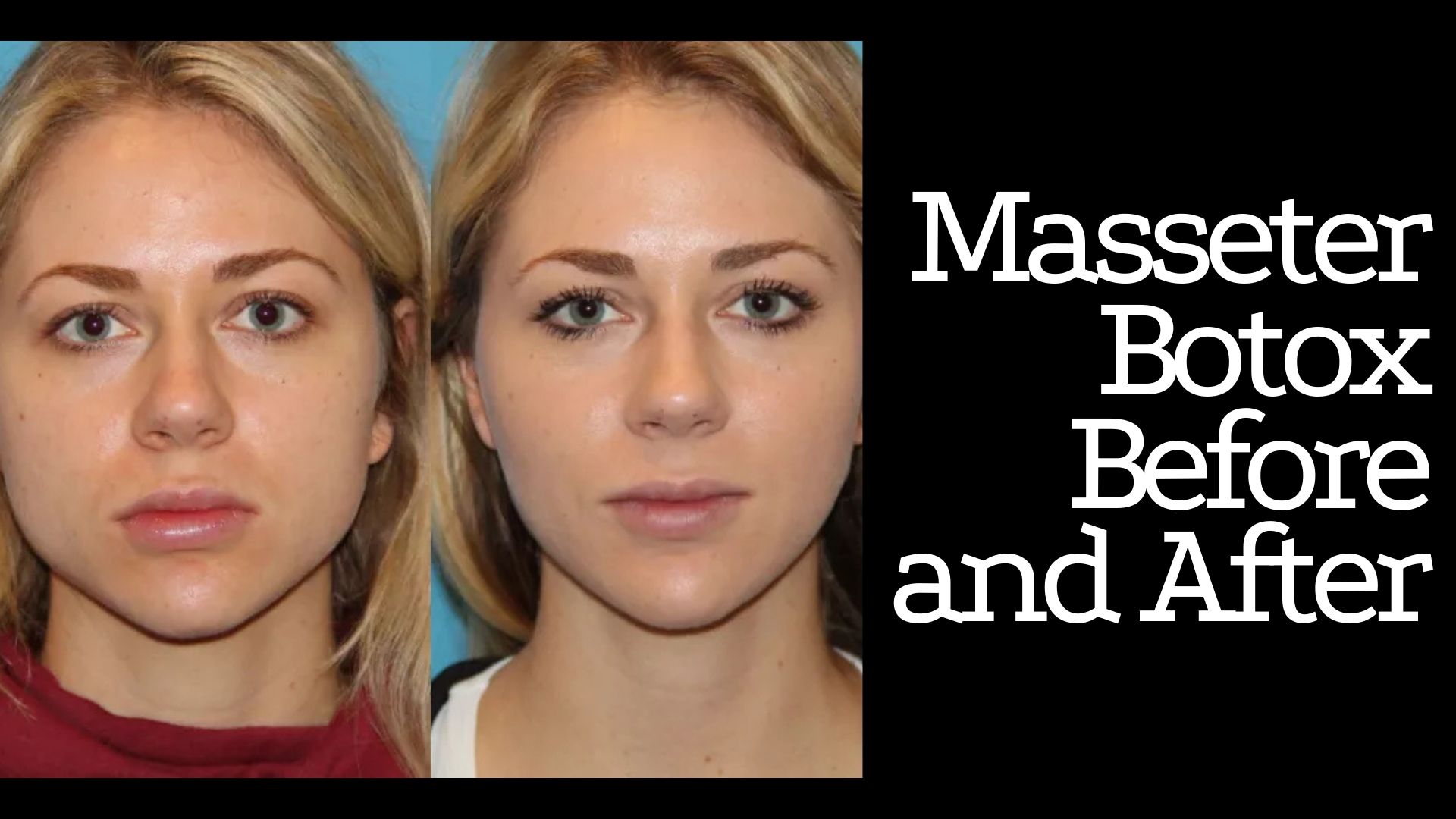 Masseter Botox Before and After | Results and Effects