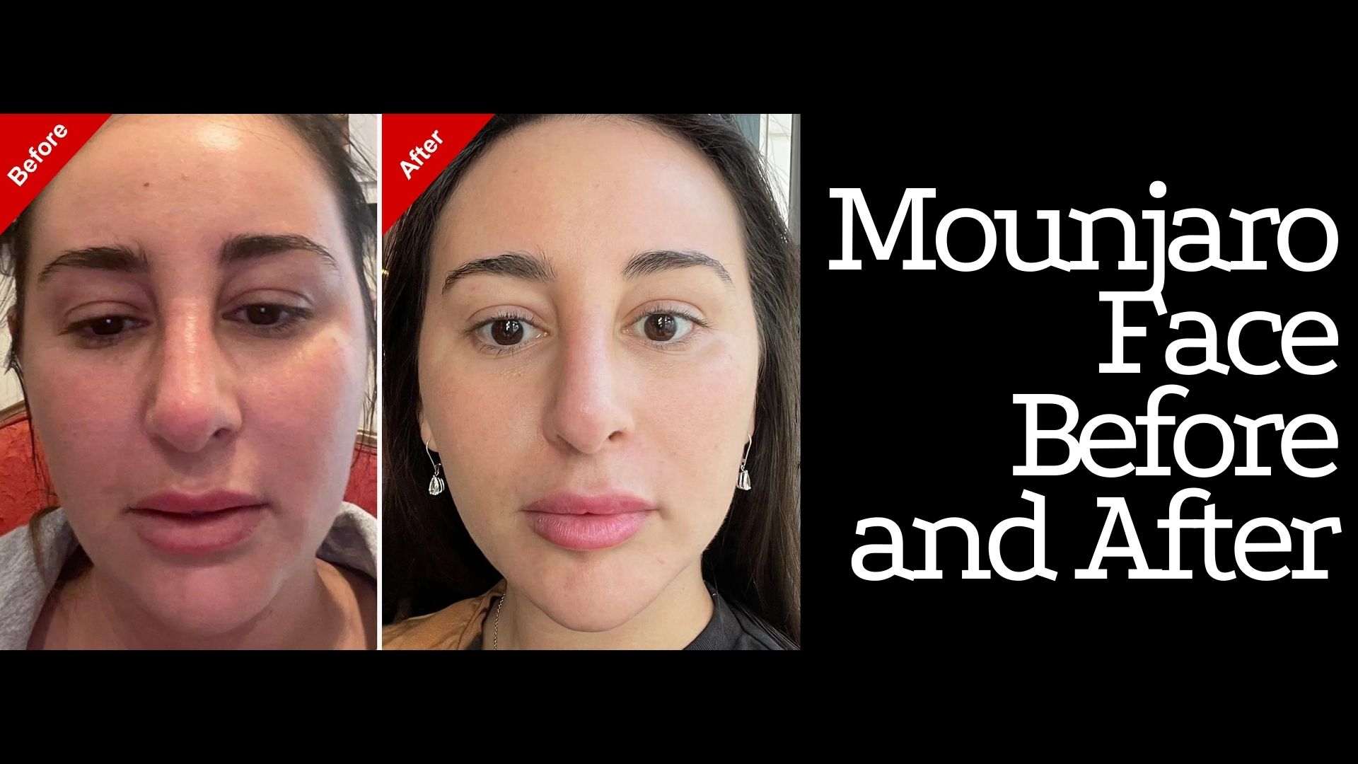 Mounjaro Face Before and After | Results and Effects
